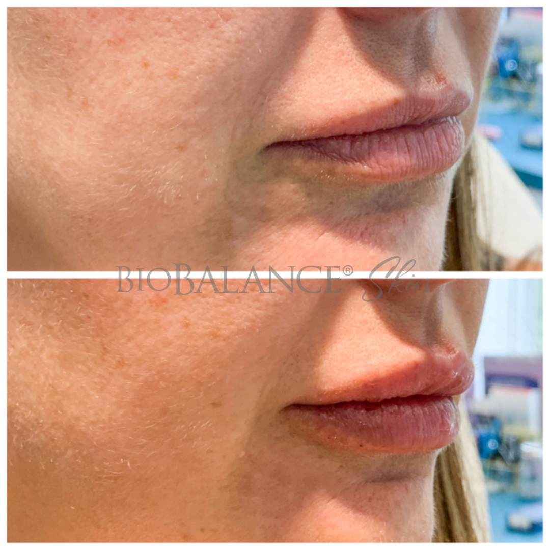 Introducing Our Newest Lip Filler: Restylane Kysse - BioBalance Skin