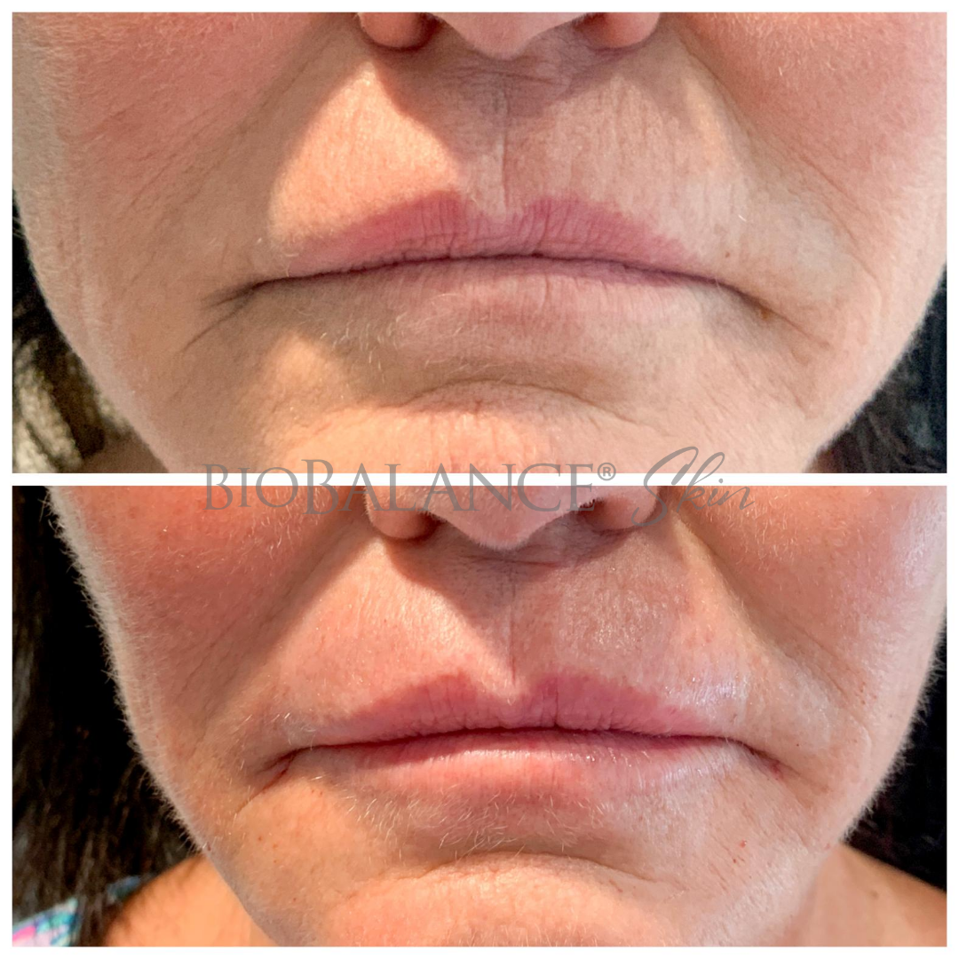 Introducing Our Newest Lip Filler: Restylane Kysse - BioBalance Skin